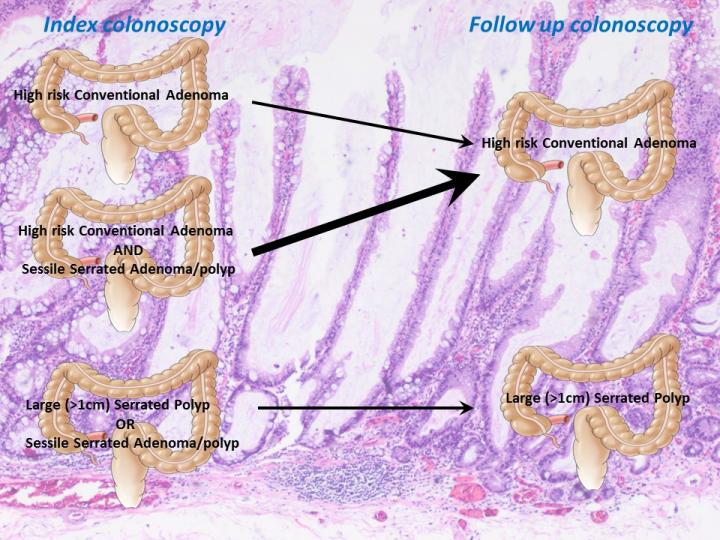 Serrated polyps plus conventional adenomas ma | EurekAlert!