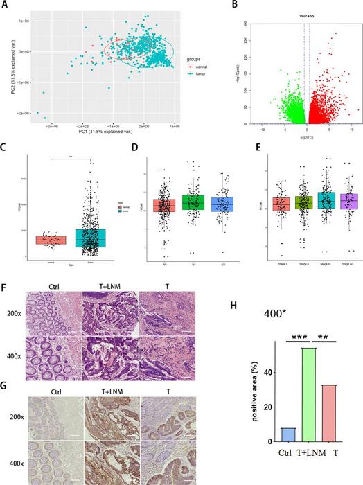Expression of PFDN6 in patient [IMAGE] | EurekAlert! Science News Releases