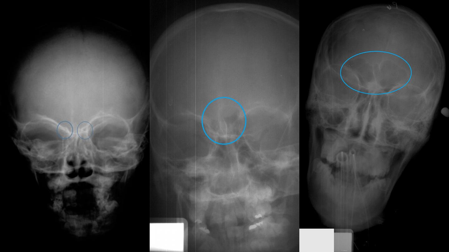 Frontal Sinus Varies With Age [IMAGE] | EurekAlert! Science News Releases