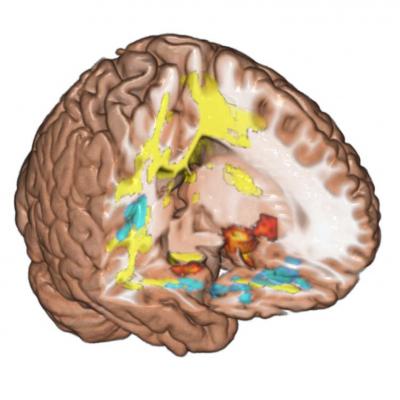 Brain Features Point to Addict [IMAGE] | EurekAlert! Science News Releases