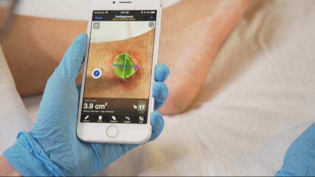 Wound care revolution: Put away your rulers a | EurekAlert!
