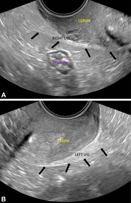 Transvaginal US in normal righ [IMAGE] | EurekAlert! Science News Releases