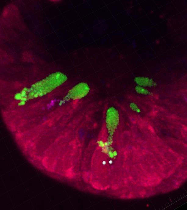Mucus retained in cystic fibrosis patients' c | EurekAlert!