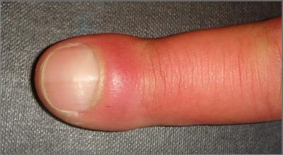 Finger Clubbing (1 of 2) [IMAGE] | EurekAlert! Science News Releases
