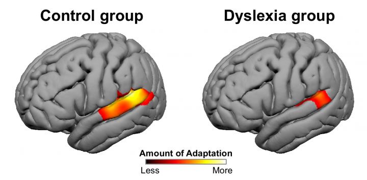 Dyslexic Brains Versus Control [IMAGE] | EurekAlert! Science News Releases