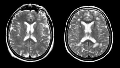 Migraine Brain Vs Normal Brain