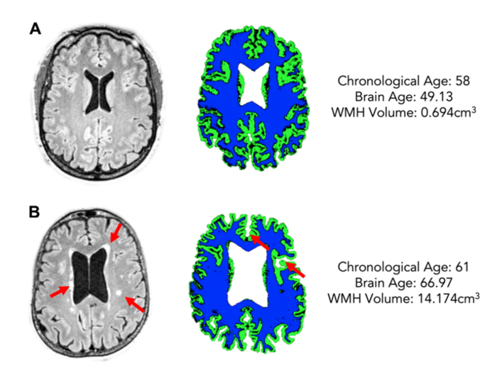 Aging | White matter hyperintensity load is a | EurekAlert! Aging | White matter hyperintensity load is a | EurekAlert!