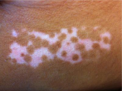 Blocking Chemical 'Sensor' Erases White Skin | EurekAlert!