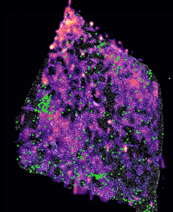 IDH-mutant human glioma tumor [IMAGE] | EurekAlert! Science News Releases