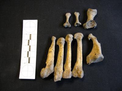 A Look at Leprosy over the Yea [IMAGE] | EurekAlert! Science News Releases