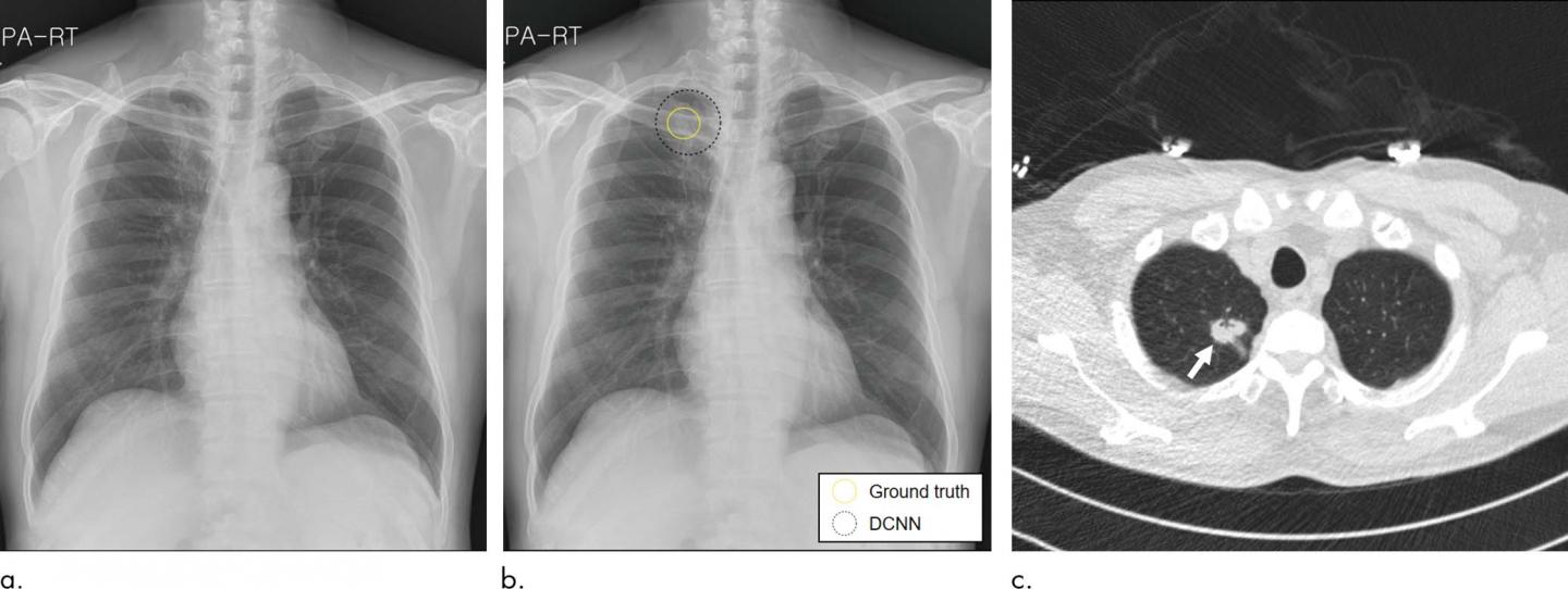 Deep learning assists in detecting malignant | EurekAlert!