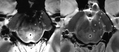 Substantia Nigra Scans (2 of 2 [IMAGE] | EurekAlert! Science News Releases