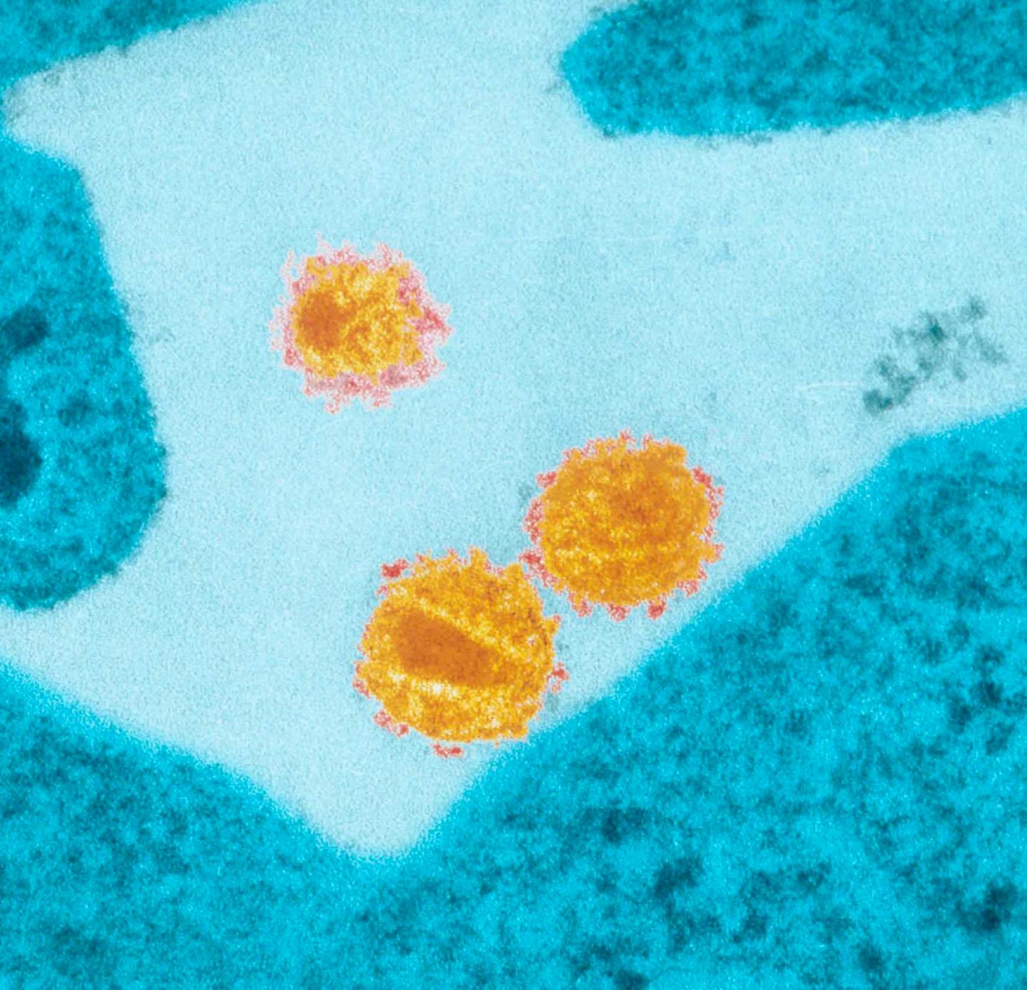 HIV Virus Particles [IMAGE] | EurekAlert! Science News Releases