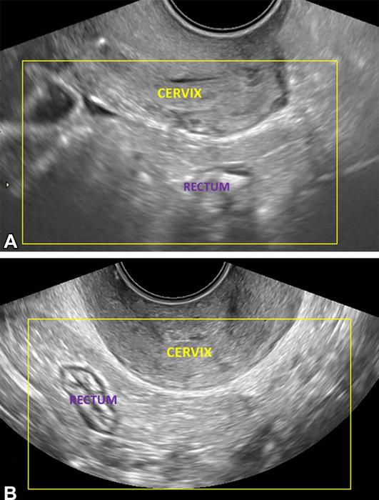 Endometriosis Ultrasound Endometriosis Bowel Ultrasound June 2023