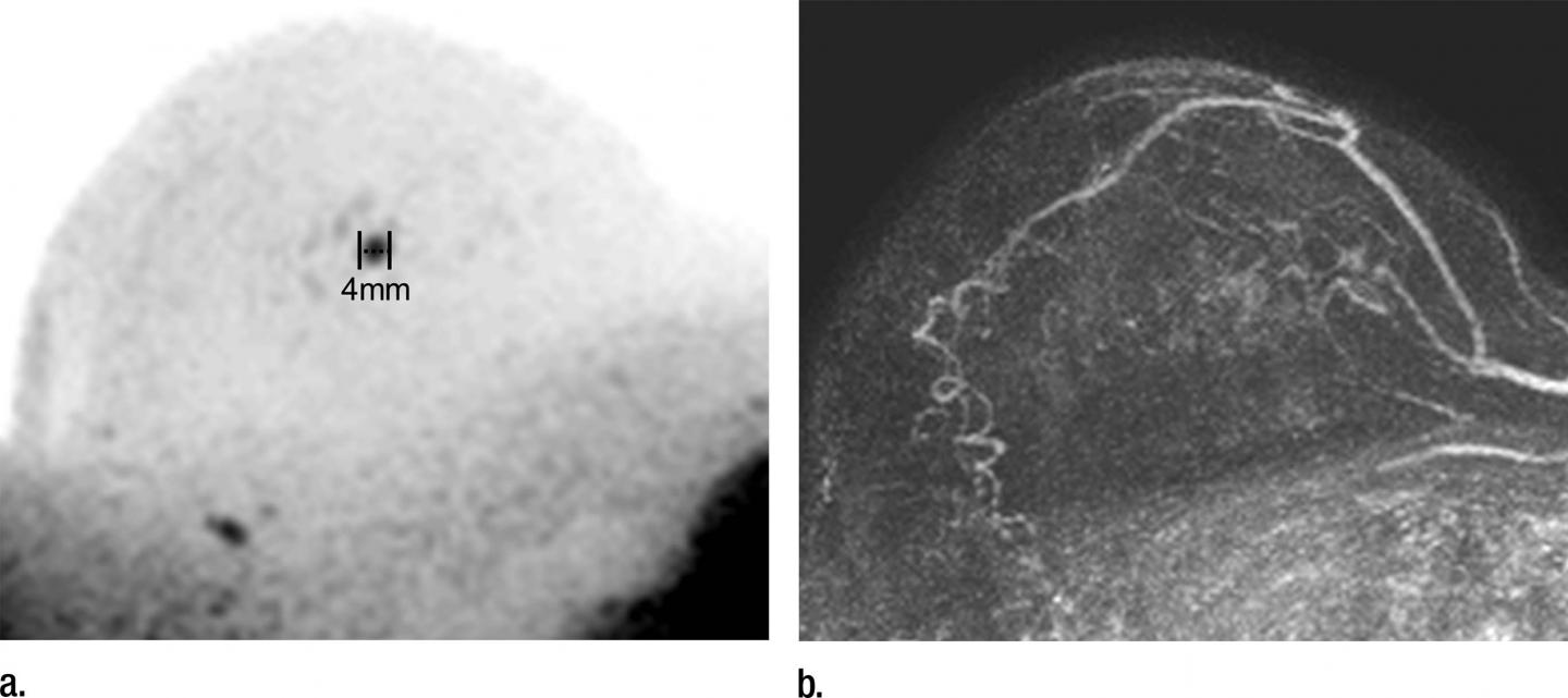 Mammogram (2 of 3) [IMAGE] | EurekAlert! Science News Releases