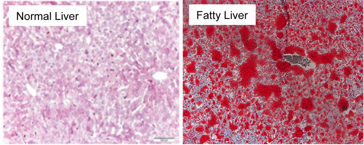 Fatty Liver [IMAGE] | EurekAlert! Science News Releases