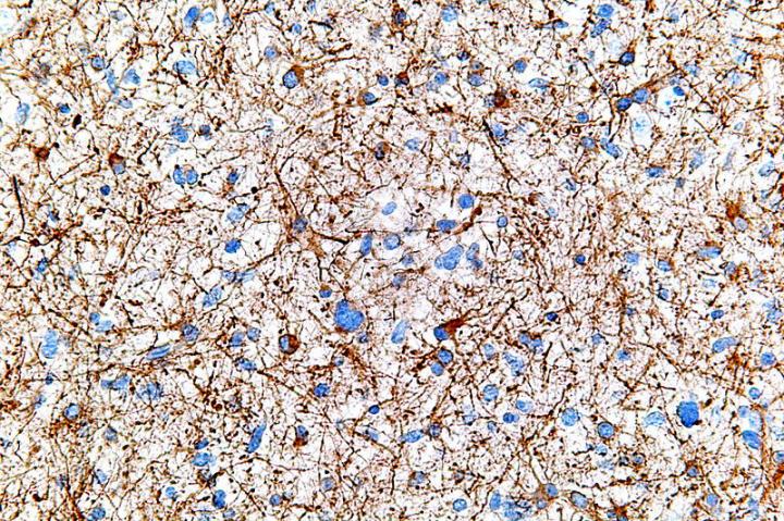 Widely Used Brain Cancer Cell Line Faces Iden | EurekAlert!