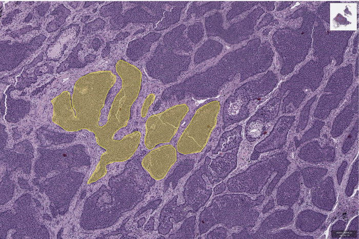 Cancer cell [IMAGE] | EurekAlert! Science News Releases