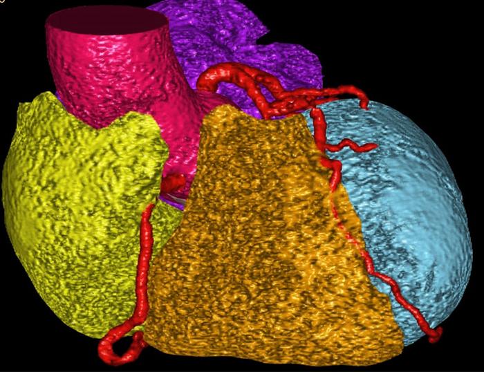 AI-enhanced heart CT [IMAGE] | EurekAlert! Science News Releases