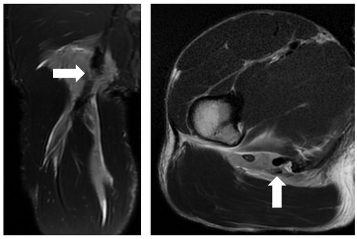 Biceps Femoris Tendon Mri