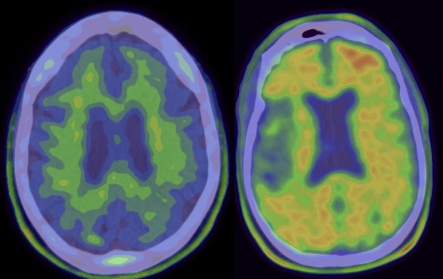 PET Scans [IMAGE] | EurekAlert! Science News Releases