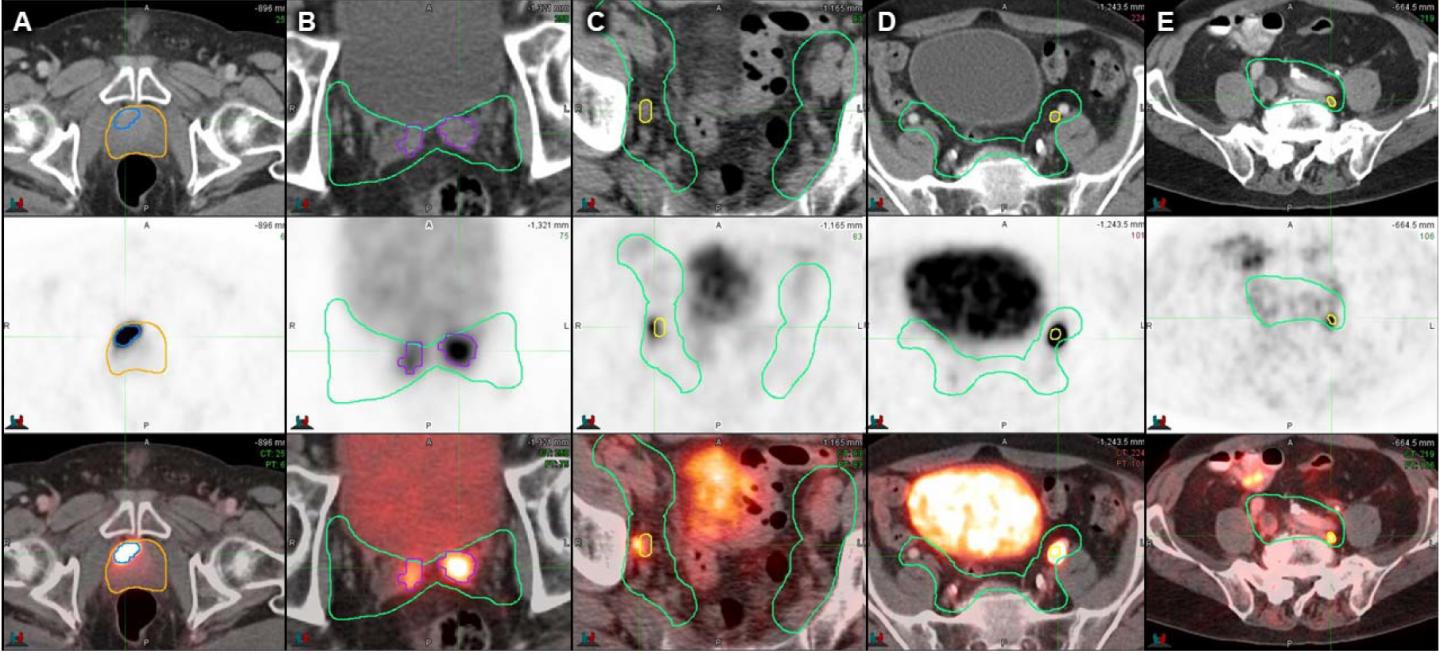 Examples of PSMA-positive Dise [IMAGE] | EurekAlert! Science News Releases