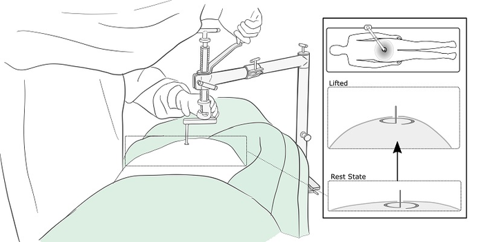 RAIS device [IMAGE] | EurekAlert! Science News Releases