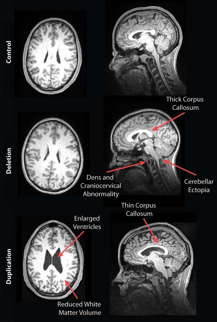 MRI reveals striking brain differences in peo | EurekAlert!