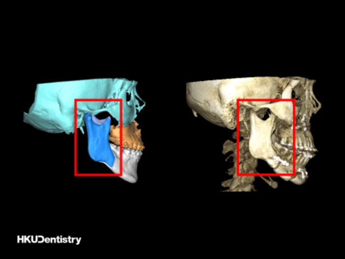 Sagittal split ramus osteotomy [IMAGE] | EurekAlert! Science News Releases
