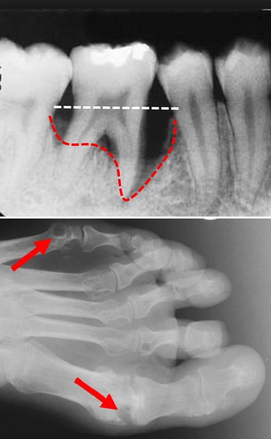 Jawbone loss predates rheumatoid arthritis | EurekAlert!