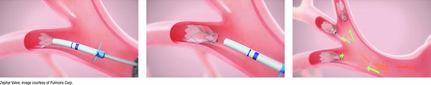 Zephyr Valve [IMAGE] | EurekAlert! Science News Releases