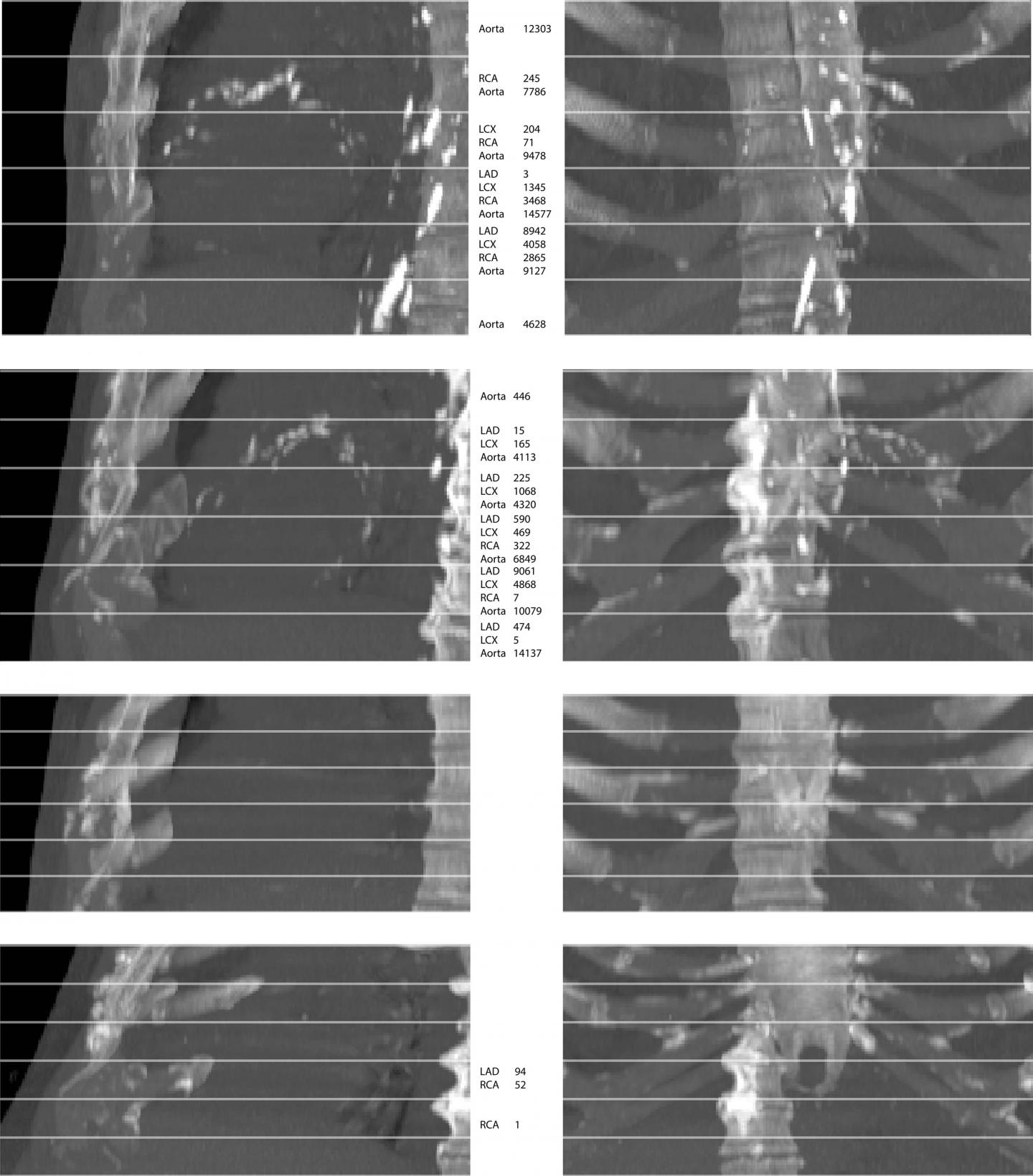 Lung Cancer Screening Predicts [IMAGE] | EurekAlert! Science News Releases