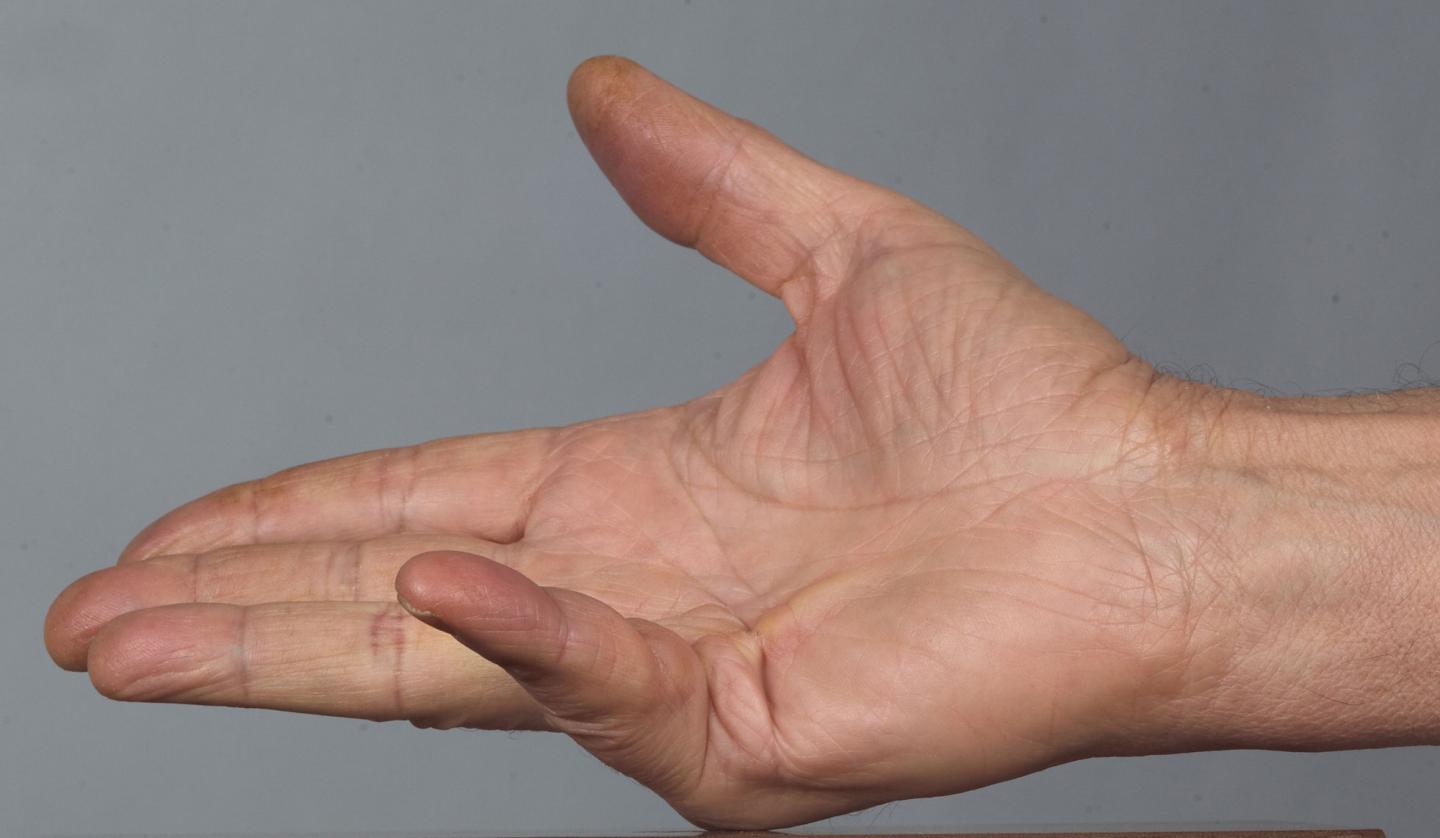 Dupuytren's Contracture [IMAGE] | EurekAlert! Science News Releases