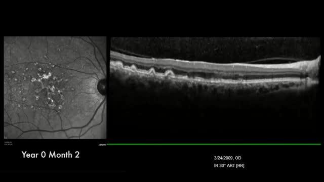 Calcified Eye Spots Linked to Progression of | EurekAlert!