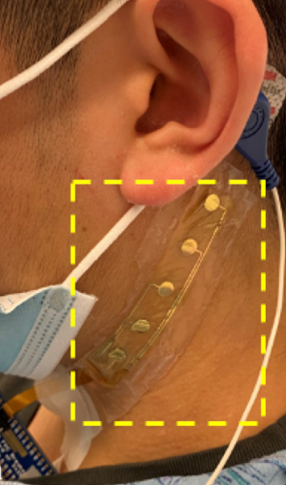 Cervical nerve monitor [IMAGE] | EurekAlert! Science News Releases