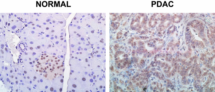 PDAC [IMAGE] | EurekAlert! Science News Releases