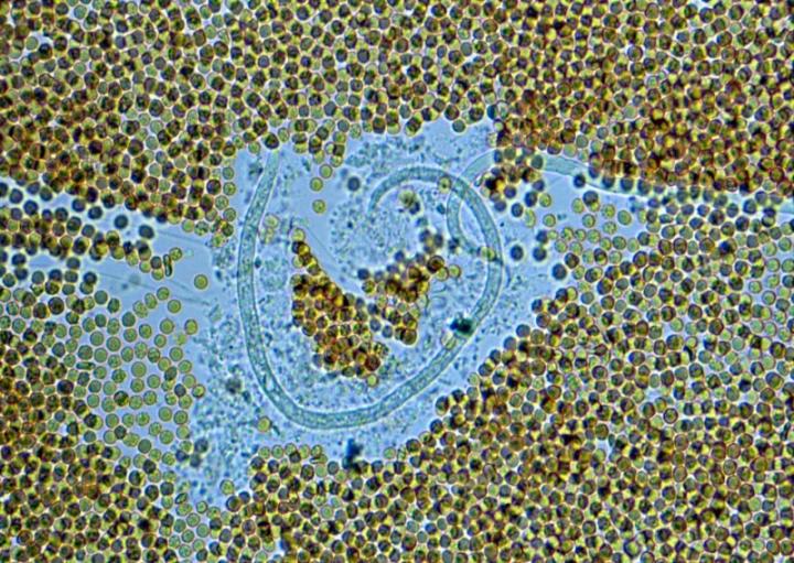 HIV/AIDS: Filarial worm infections double the | EurekAlert!