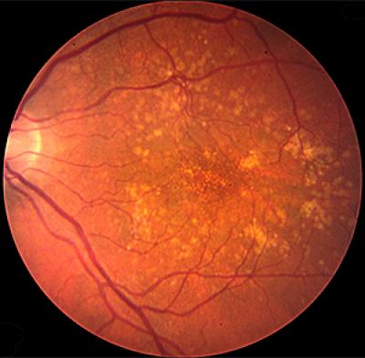 Cholesterol Deposits in the Re [IMAGE] | EurekAlert! Science News Releases