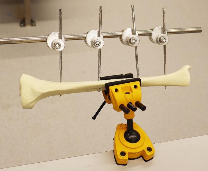 Affordable device for fixing broken bones pil | EurekAlert!