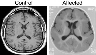 Genetic mutation underlying severe childhood | EurekAlert!