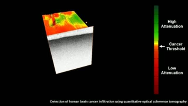 Imaging Technology Identifies Invasive Brain | EurekAlert!