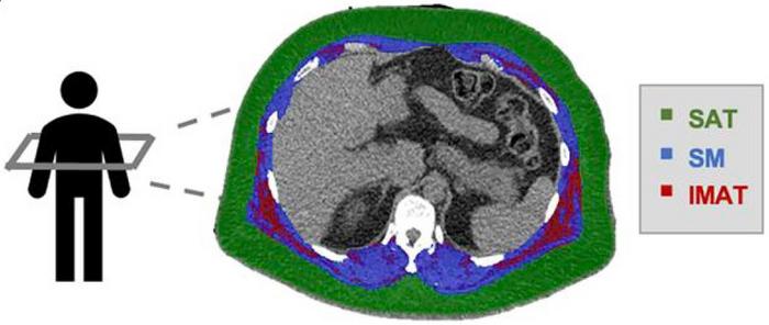 CT scan showing body compositi [IMAGE] | EurekAlert! Science News Releases