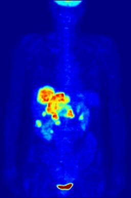 Whole-Body PET Scan [IMAGE] | EurekAlert! Science News Releases