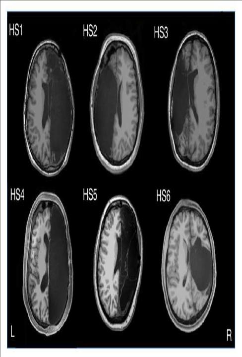 fMRI Scan of Adults with One H [IMAGE] | EurekAlert! Science News Releases
