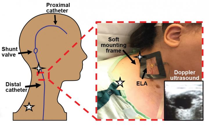 Wireless Skin Sensors Detect Shunt Malfunctio | EurekAlert!