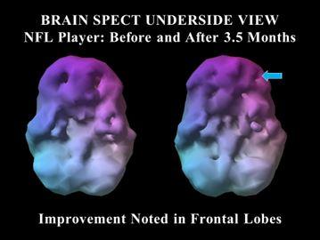 Spect Brain Scan