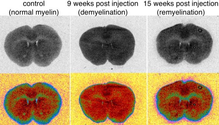 Normal Myelin, Demyelination, [IMAGE] | EurekAlert! Science News Releases