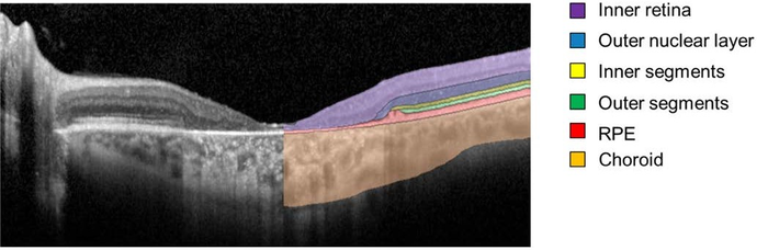 Retina layers segmented by dee [IMAGE] | EurekAlert! Science News Releases