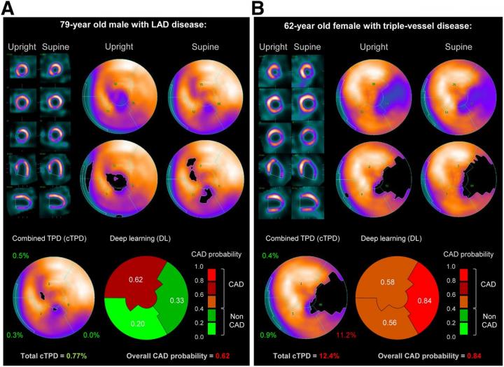 Prediction of Obstructive CAD [IMAGE] | EurekAlert! Science News Releases