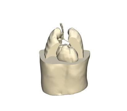 Cardiovascular diseases: New computer model i | EurekAlert!